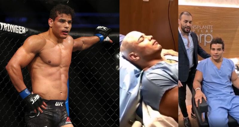 Did Paulo Costa get a hair transplant?