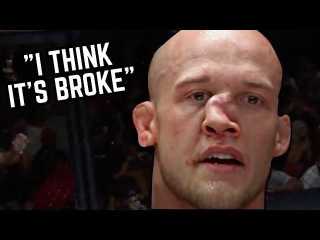 Doctor gives medical breakdown after MMA fighter suffers horrific nose ...