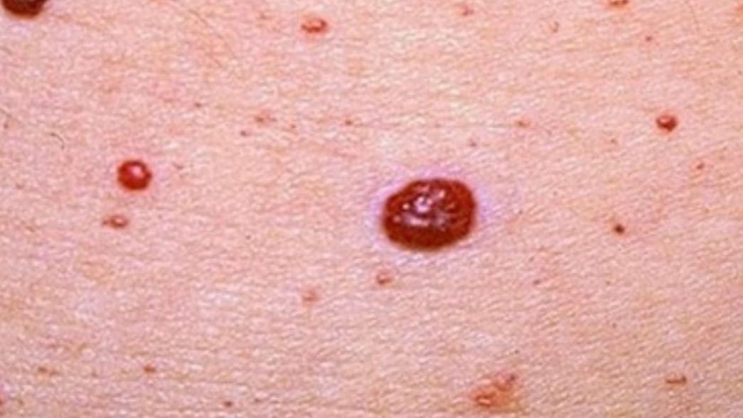 Red moles on skin: Causes and treatment options