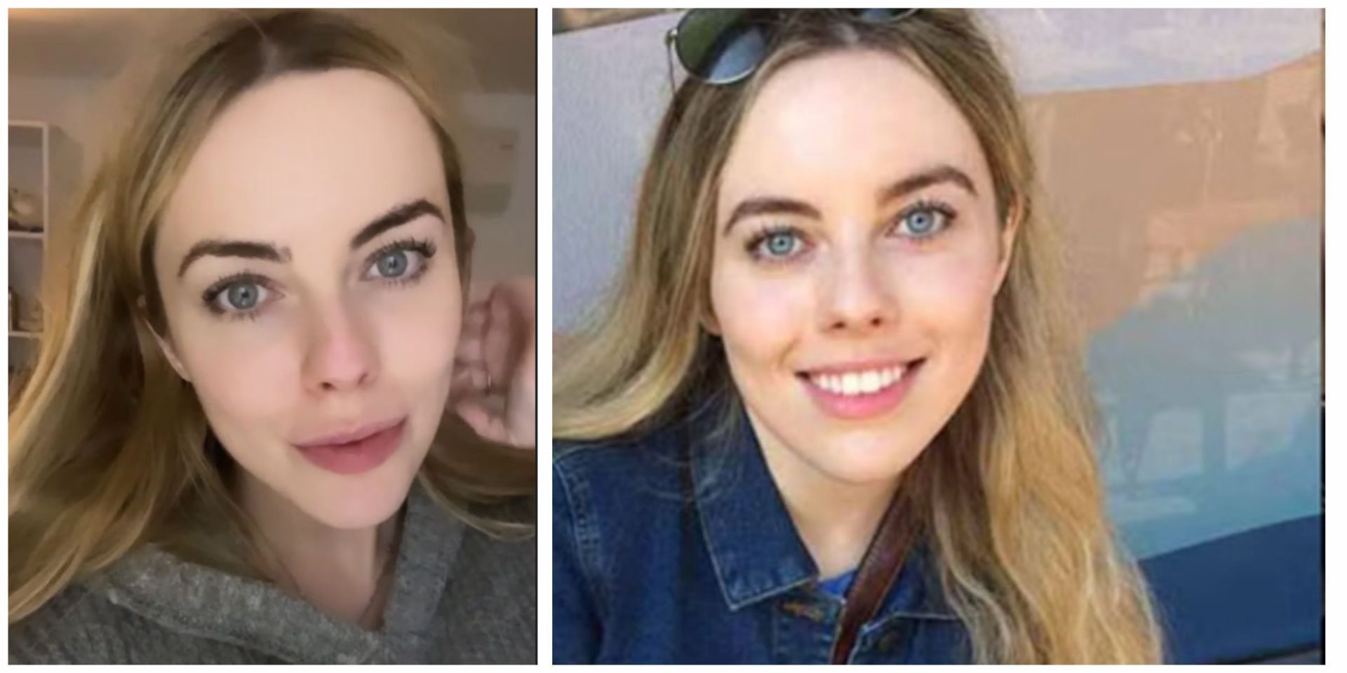 What is Chiari malformation? Symptoms explored as Emily Balfour GoFundMe raises more than £28,000